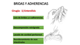 Obstrucción intestinal | PPTX