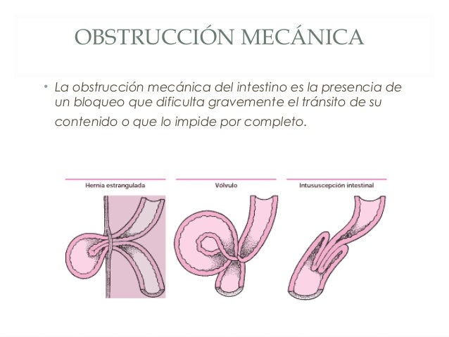 Obstrucción intestinal