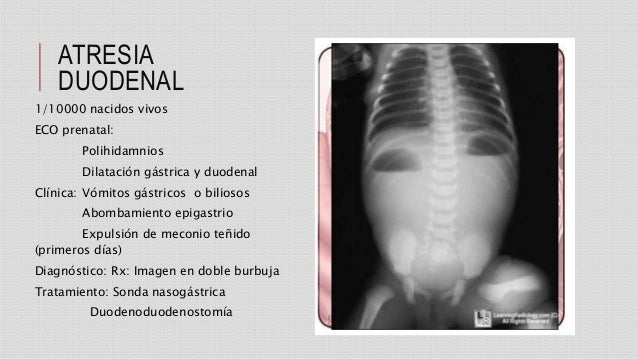 Obstrucción intestinal