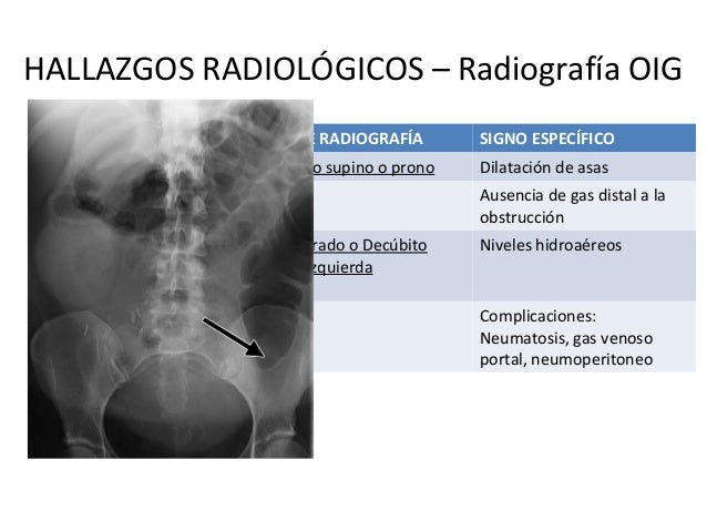 Obstrucción intestinal