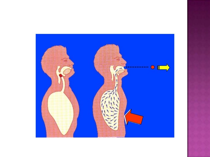 ObstruccióN Via Aerea