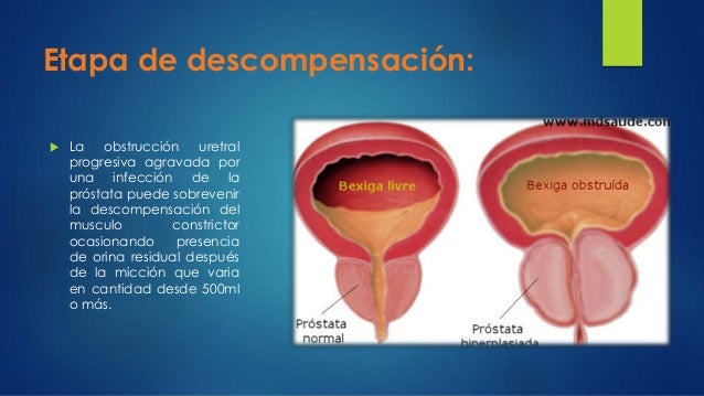 Obstrucción y estasis urinaria