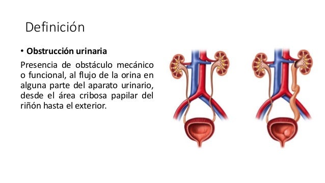 Obstrucción y estasis urinarias