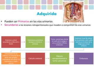 Obstrucción y Estasis urinarias (1) | PPTX