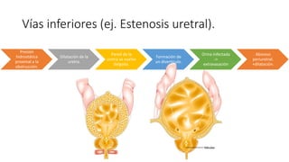 Obstrucción y estasis urinaria | PPTX
