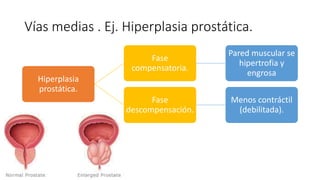 Obstrucción y estasis urinaria | PPTX