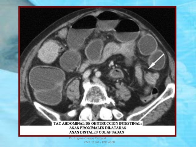 OBSTRUCCION INTESTINAL PARTE 1