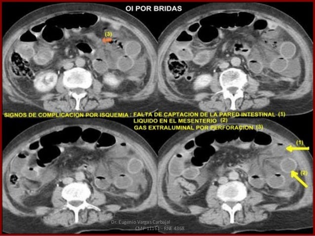 OBSTRUCCION INTESTINAL PARTE 1
