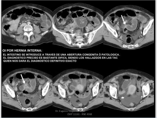 OBSTRUCCION INTESTINAL PARTE 1