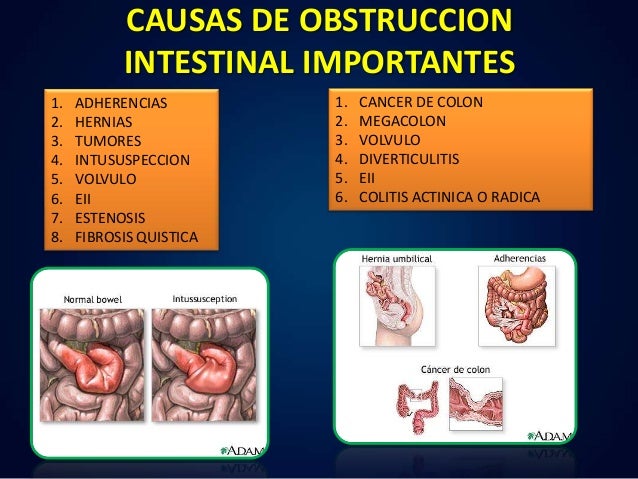 Obstruccion intestinal