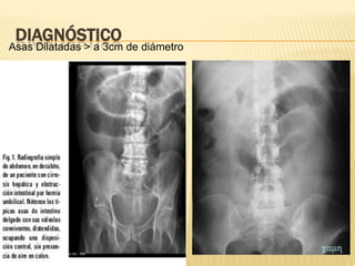 Obstruccion intestinal (1) | PPT