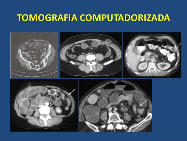 Obstruccion intestinal