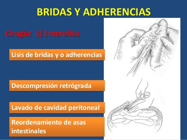 Obstruccion intestinal