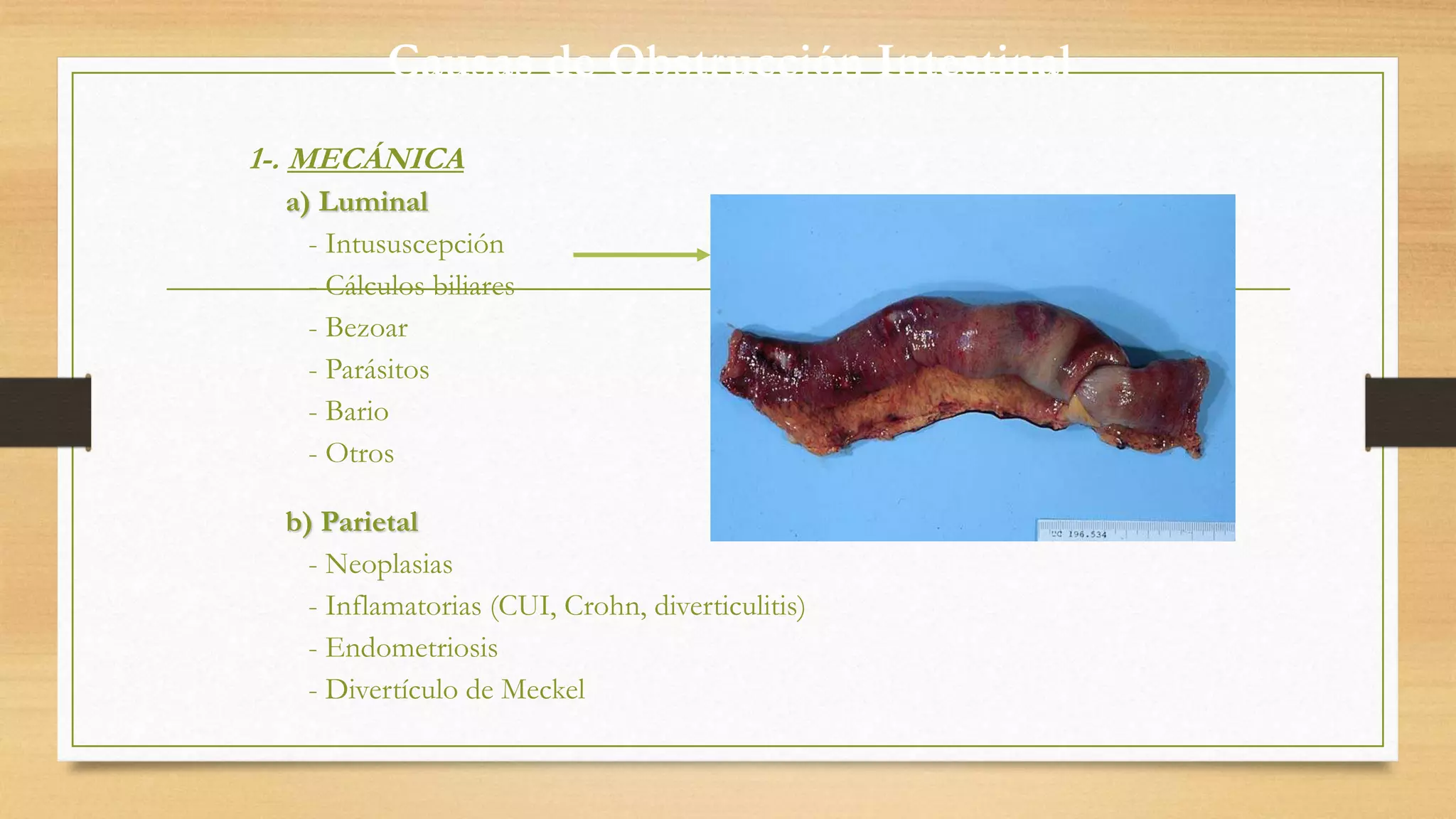 Obstruccion intestinal cirugia | PPTX | Digestive Disorders | Diseases ...