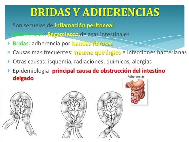 Obstruccionintestinal buap 2017 jrvrm