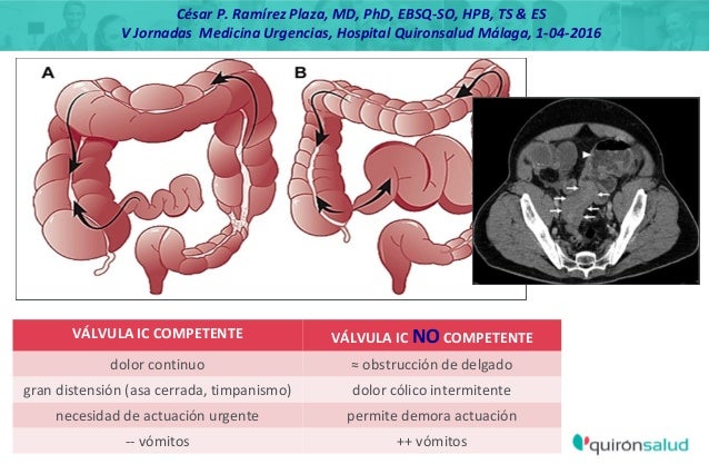 Obstrucción Intestinal como emergencia quirúrgica