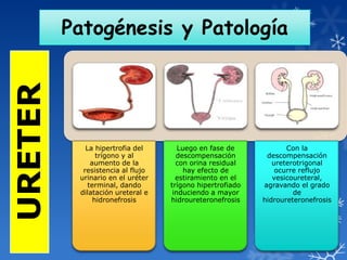 Obstruccion y estasis urinaria | PPTX