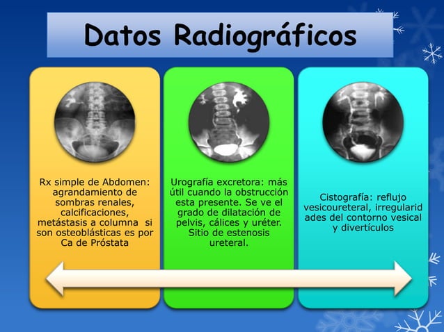 Obstruccion y estasis urinaria | PPTX