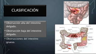 Obstrucion intestinal | PPTX