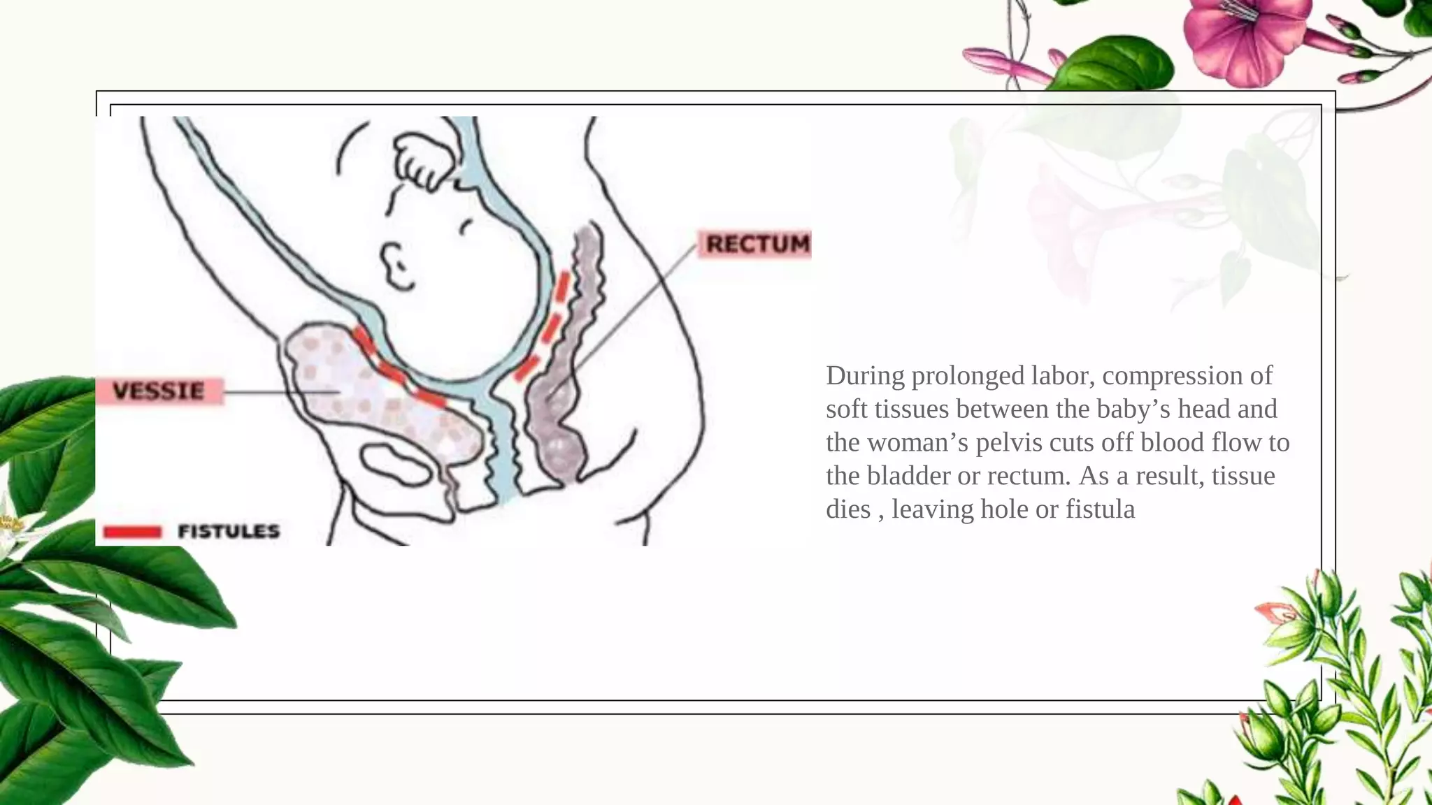 Obstructed labour | PPTX