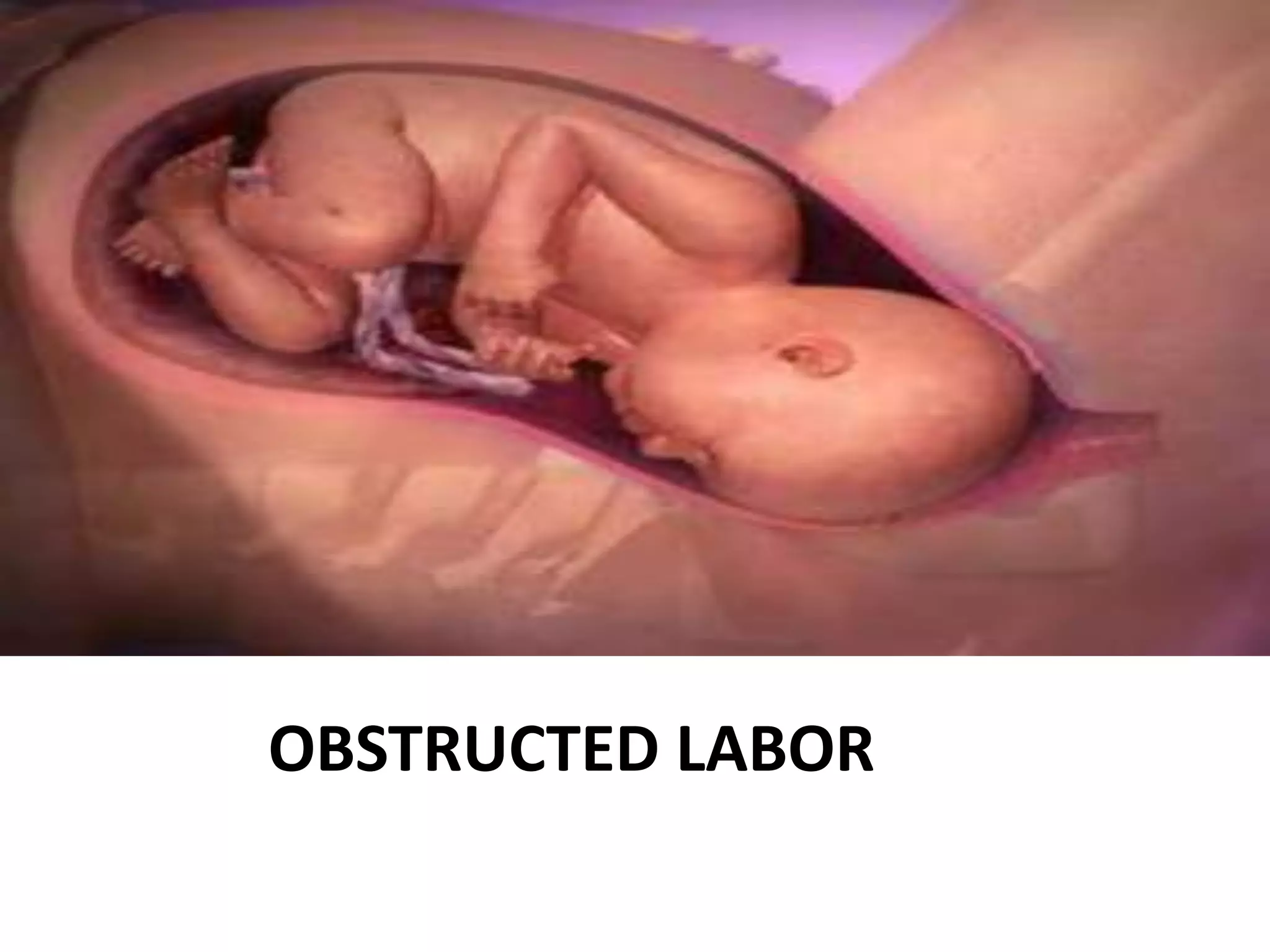 Obstructed labor | PPTX