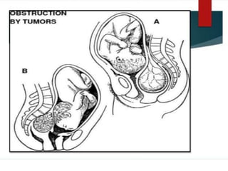 Obstructed labor | PPTX