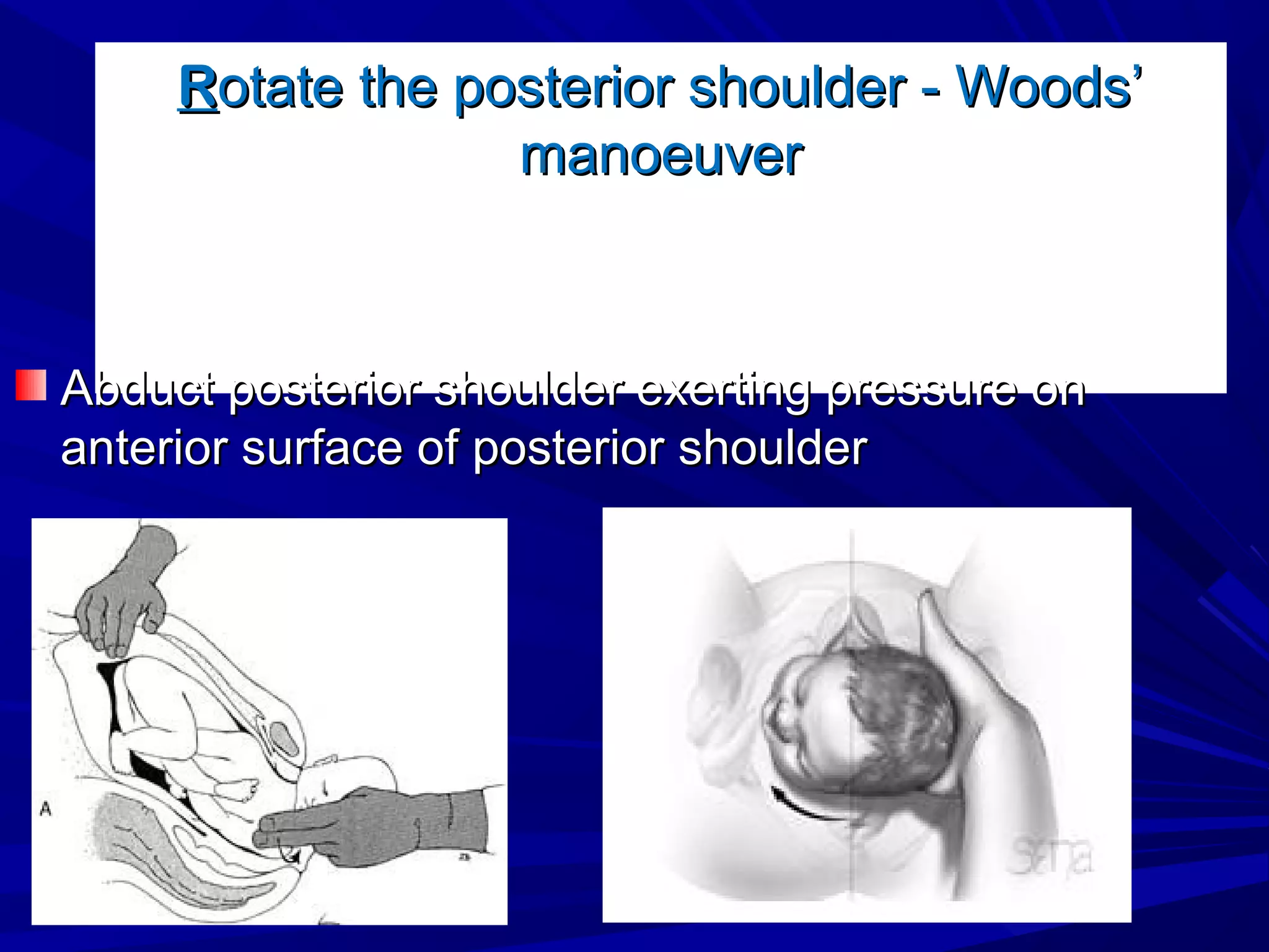 Obstructed labor and shoulder dystocia for undergraduate | PPT