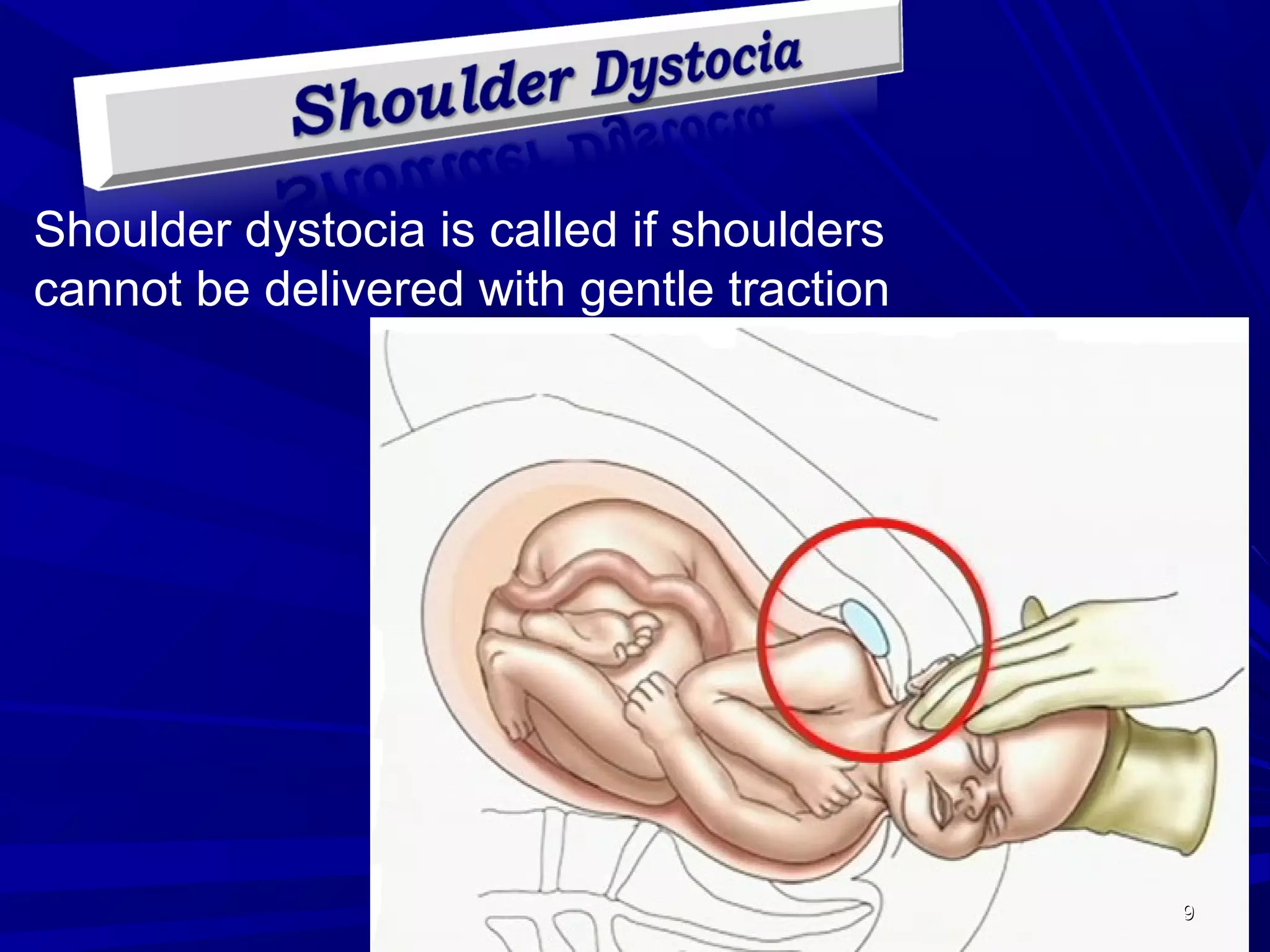 Obstructed labor and shoulder dystocia for undergraduate | PPT