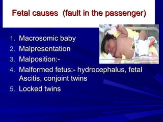Obstructed labor and shoulder dystocia for undergraduate | PPT