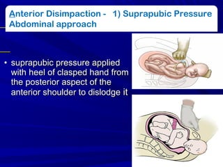 Shoulder Dystocia Suprapubic Pressure