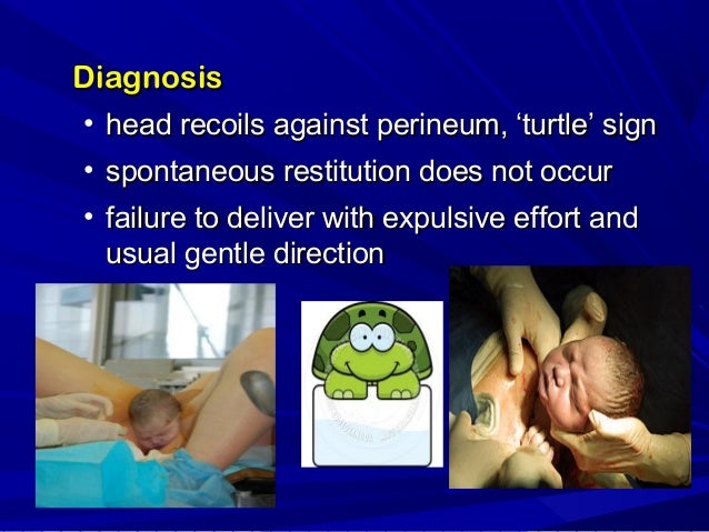 Obstructed labor and shoulder dystocia for undergraduate