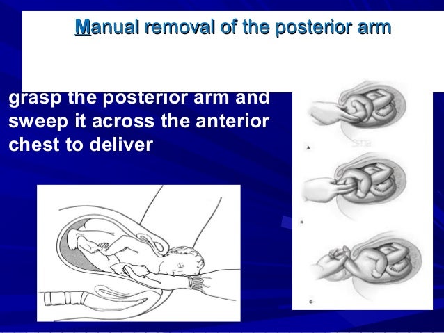 Gaskin Maneuver Shoulder Dystocia