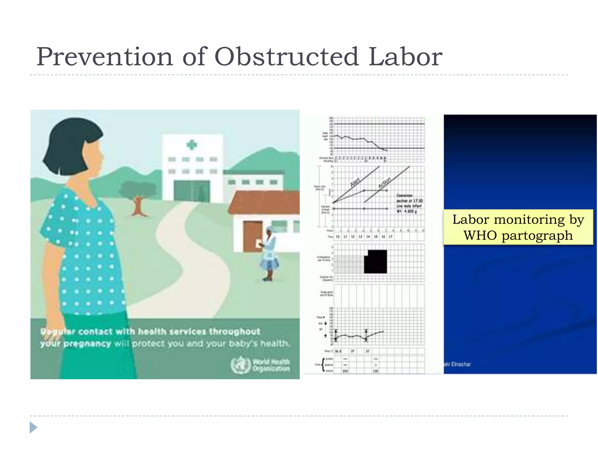 Obstructed labor and uterine rupture | PPTX