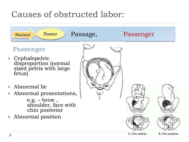Obstructed labor and uterine rupture | PPTX