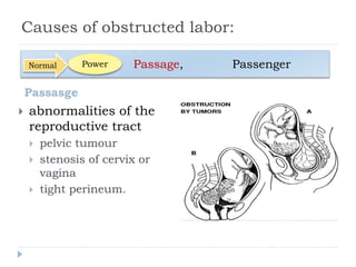 Obstructed labor and uterine rupture | PPTX