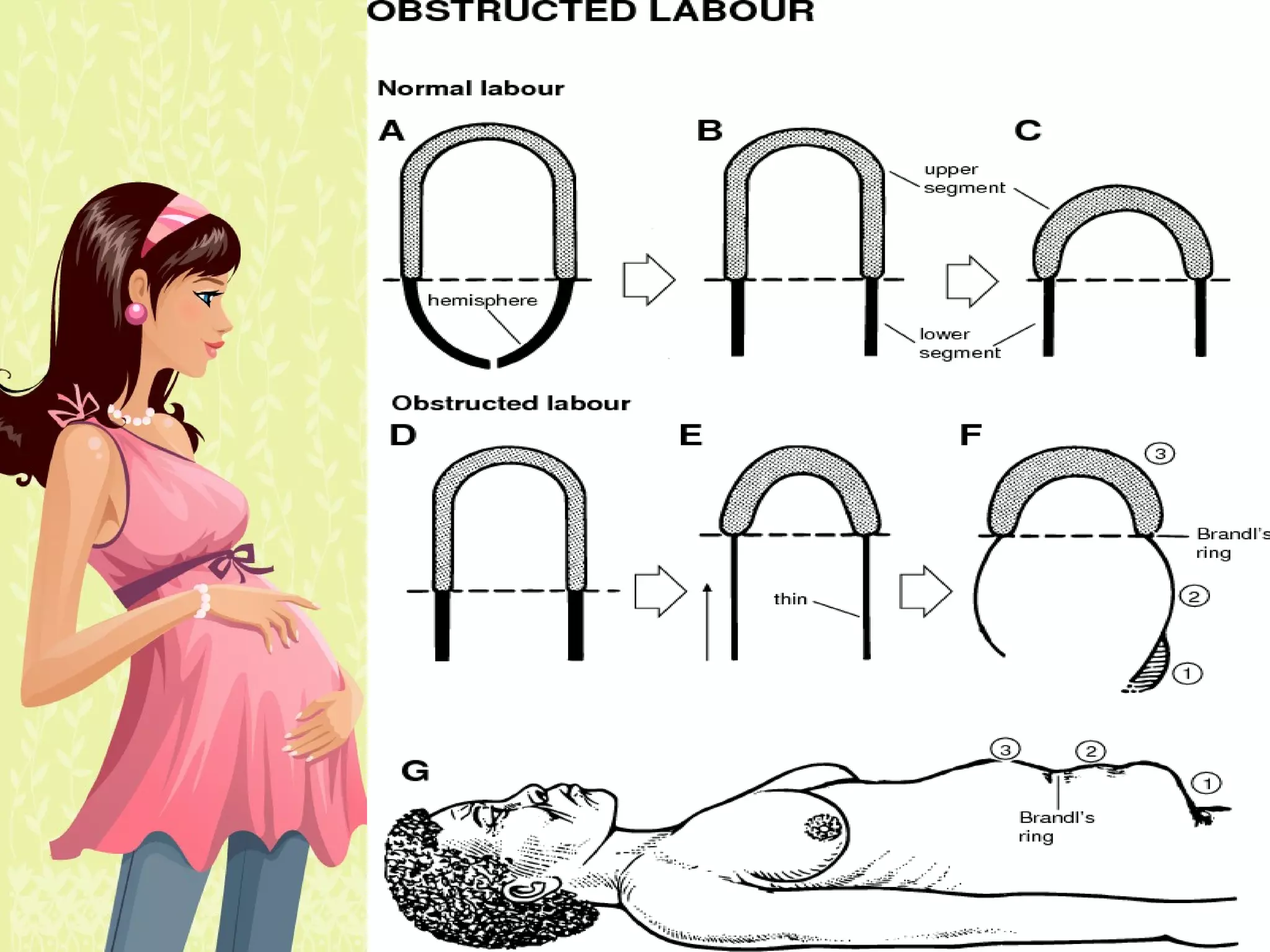 Obstructed labour | PPT