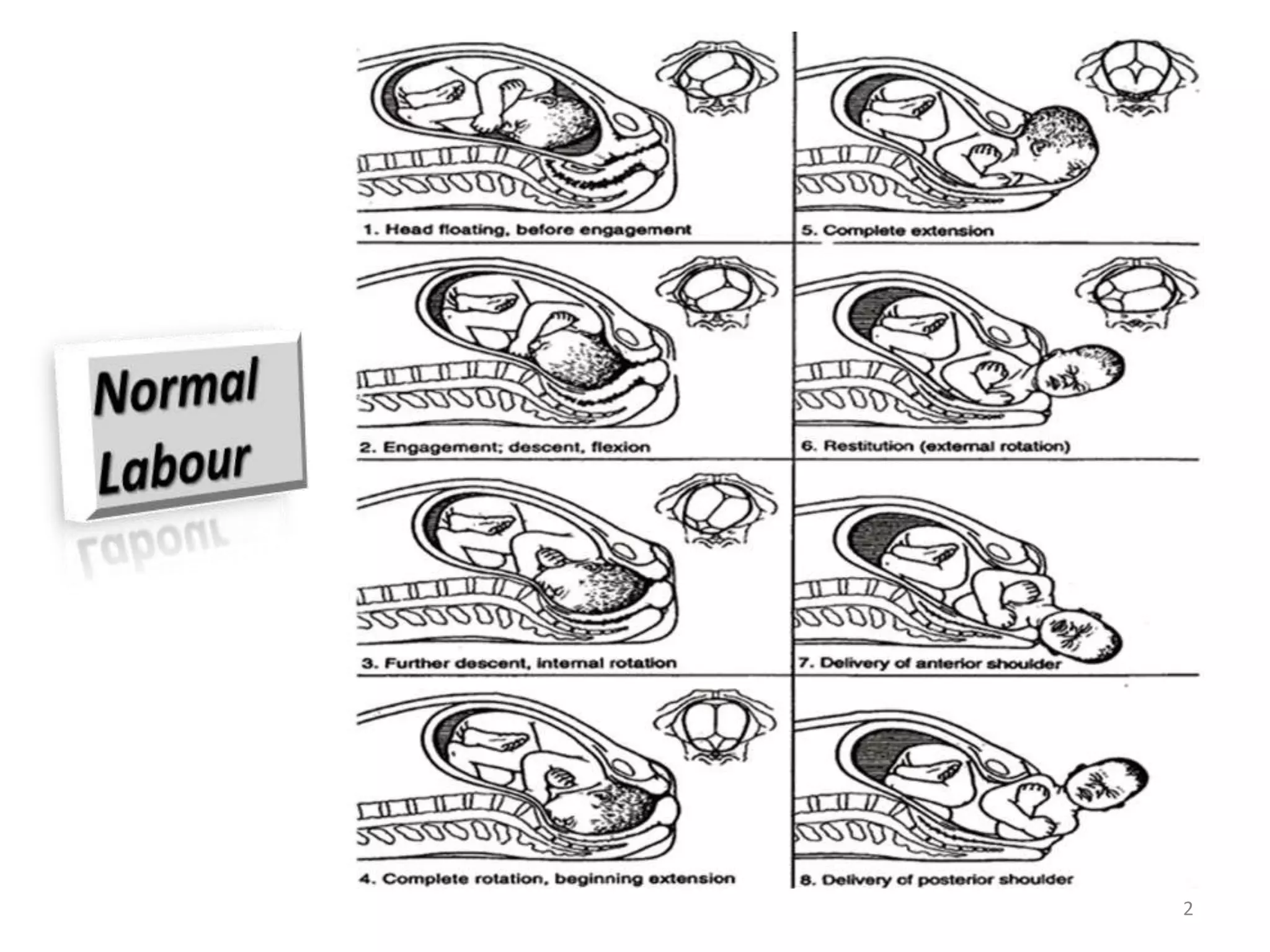 Obstructed labour | PPTX