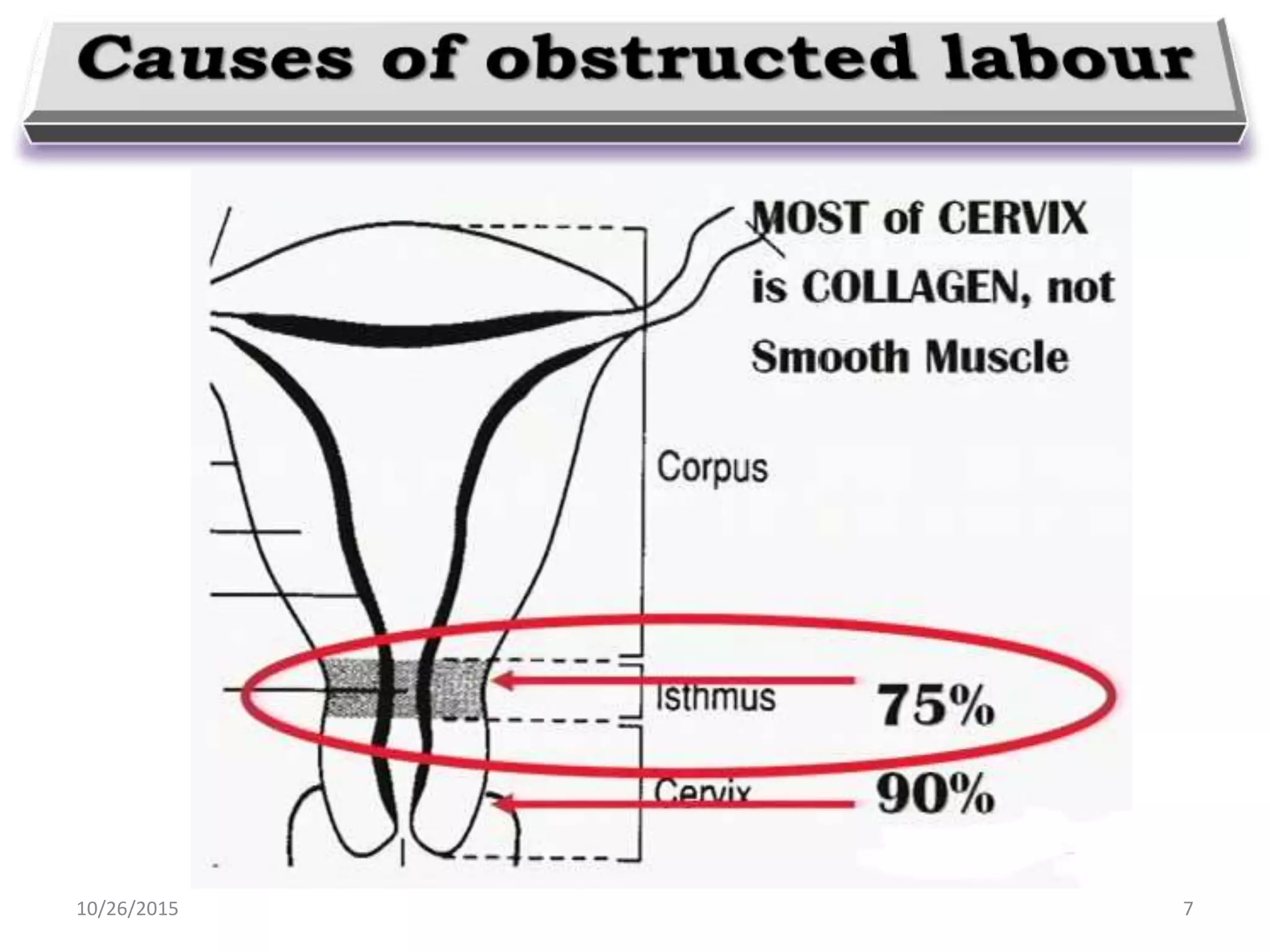 Obstructed labour | PPTX