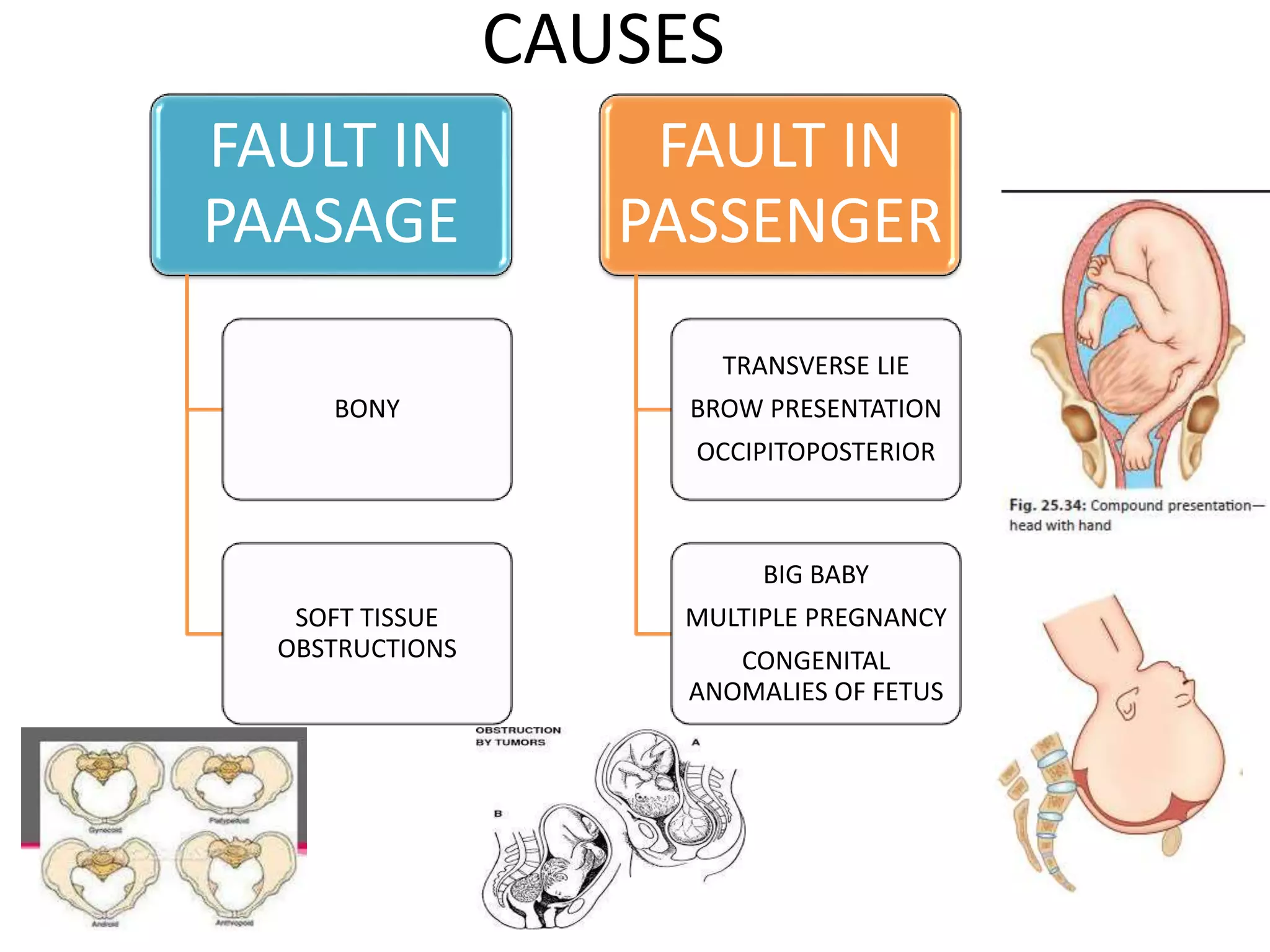 Obstructed labour | PPTX