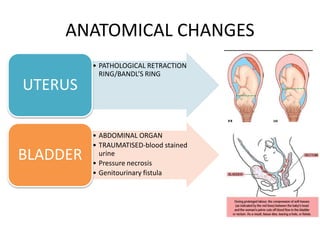 Obstructed labour | PPTX