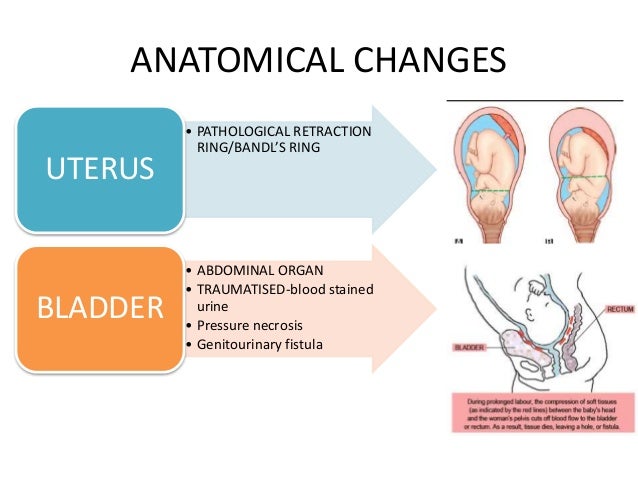 Uterus Contraction Ring Obstructed Labour