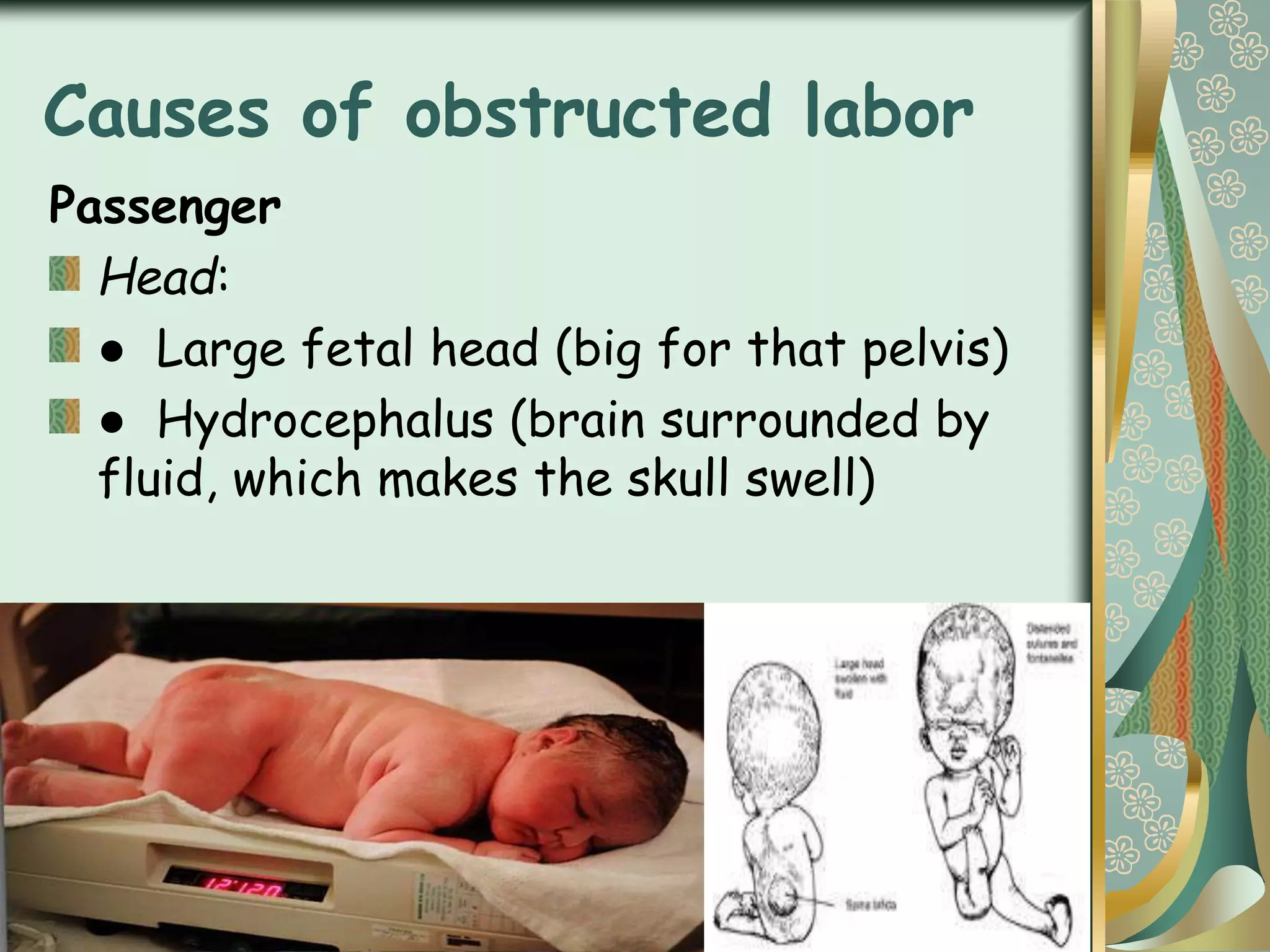 Obstructed labor | PPTX