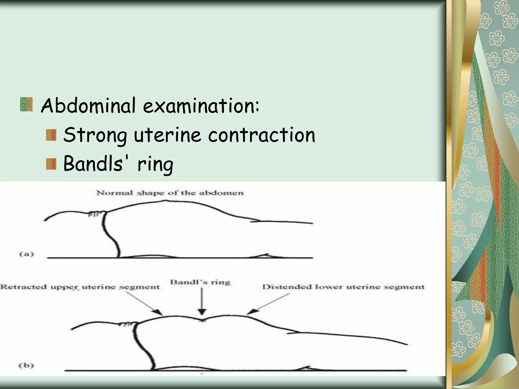 Obstructed labor | PPTX