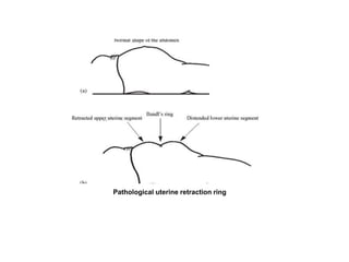 Obstructed labour | PPTX