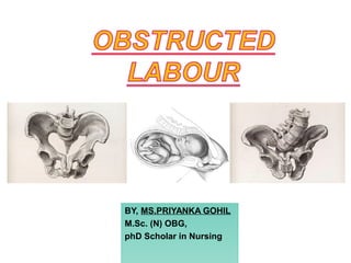 Obstructed labour | PPT