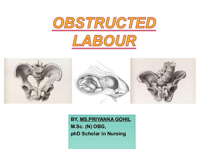 Obstructed labour