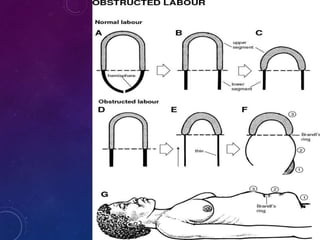 OBSTRUCTED LABOUR.pptx