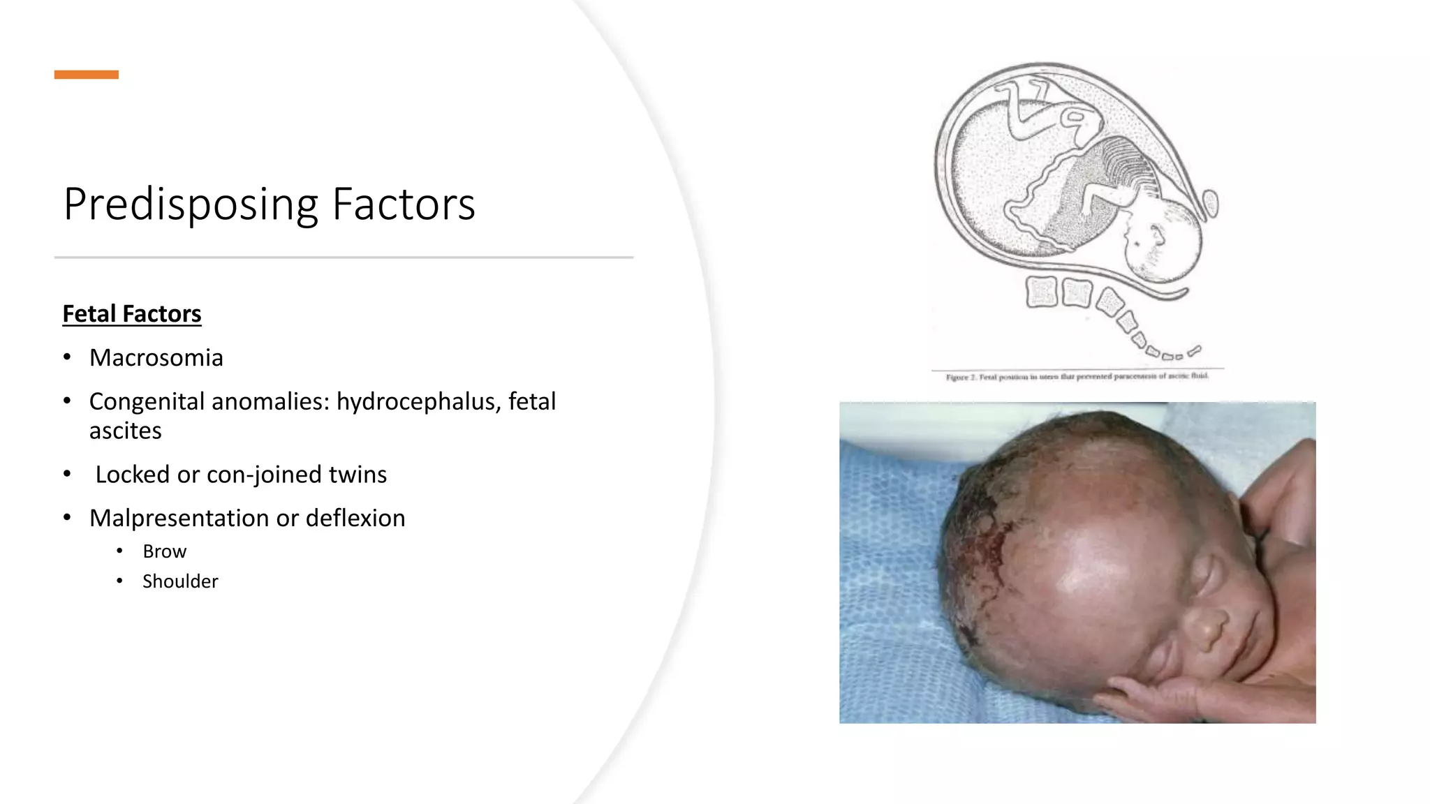 Obstructed Labour.pptx