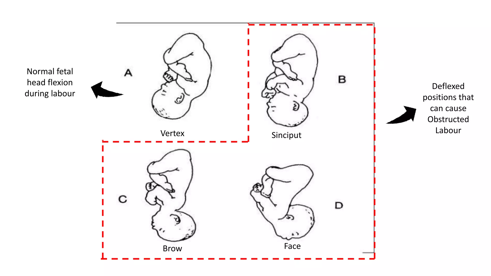 Obstructed Labour.pptx