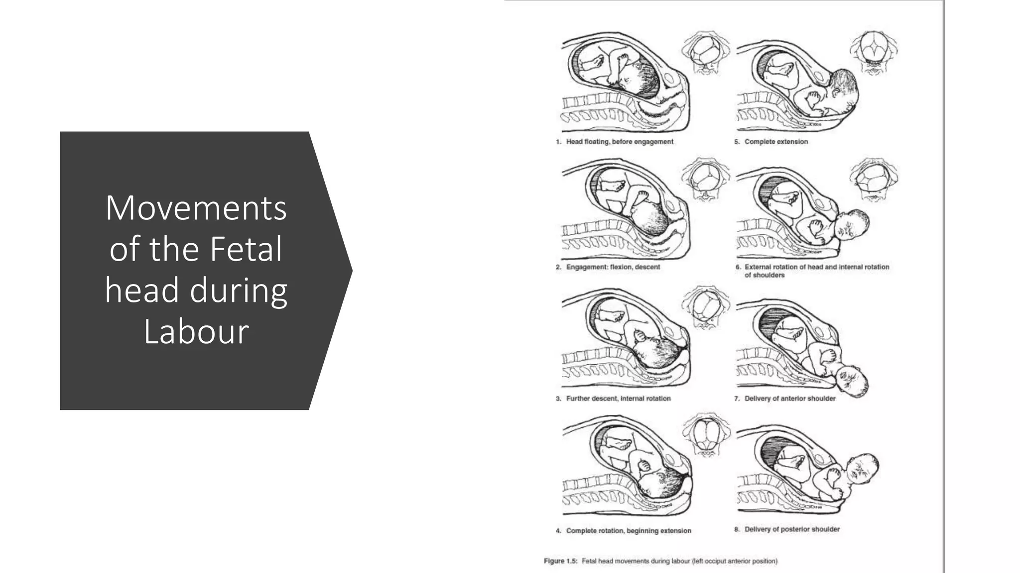 Obstructed Labour.pptx